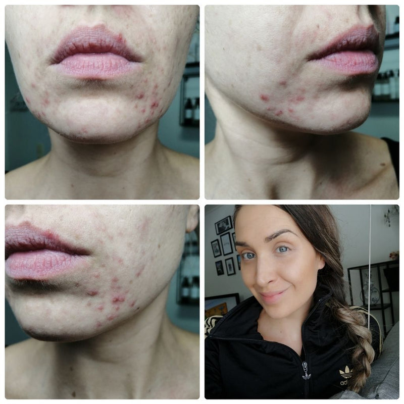 Perioraalidermatiitti, Suunympärysihottuma - hoito&tuotteet - Twistbe